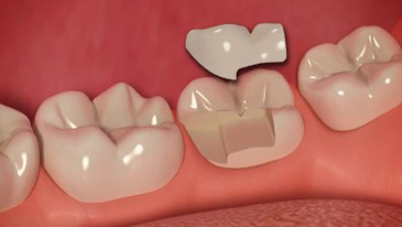 Cerec Onlay – Asheville Holistic Dentist